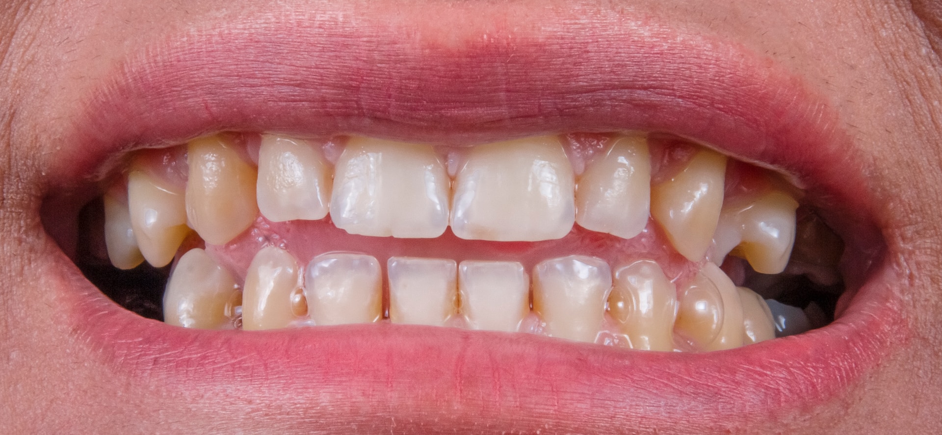 Dental Bonding for a Chipped Tooth - TJ Smile Dental